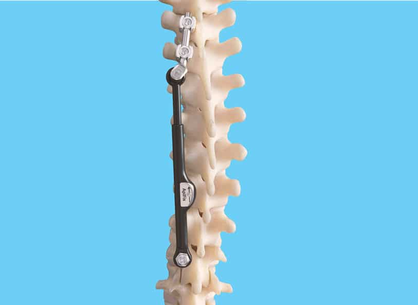 ApiFix: dispositivo interno para corrección de la escoliosis